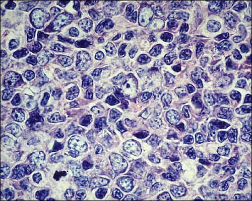 Malignes Lymphom _ bfdecont
